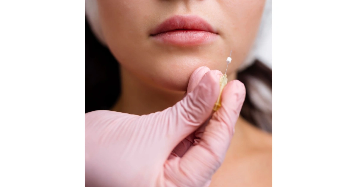 PDO Thread Lift Manchester, NH | Rejuvenate and Lift Skin